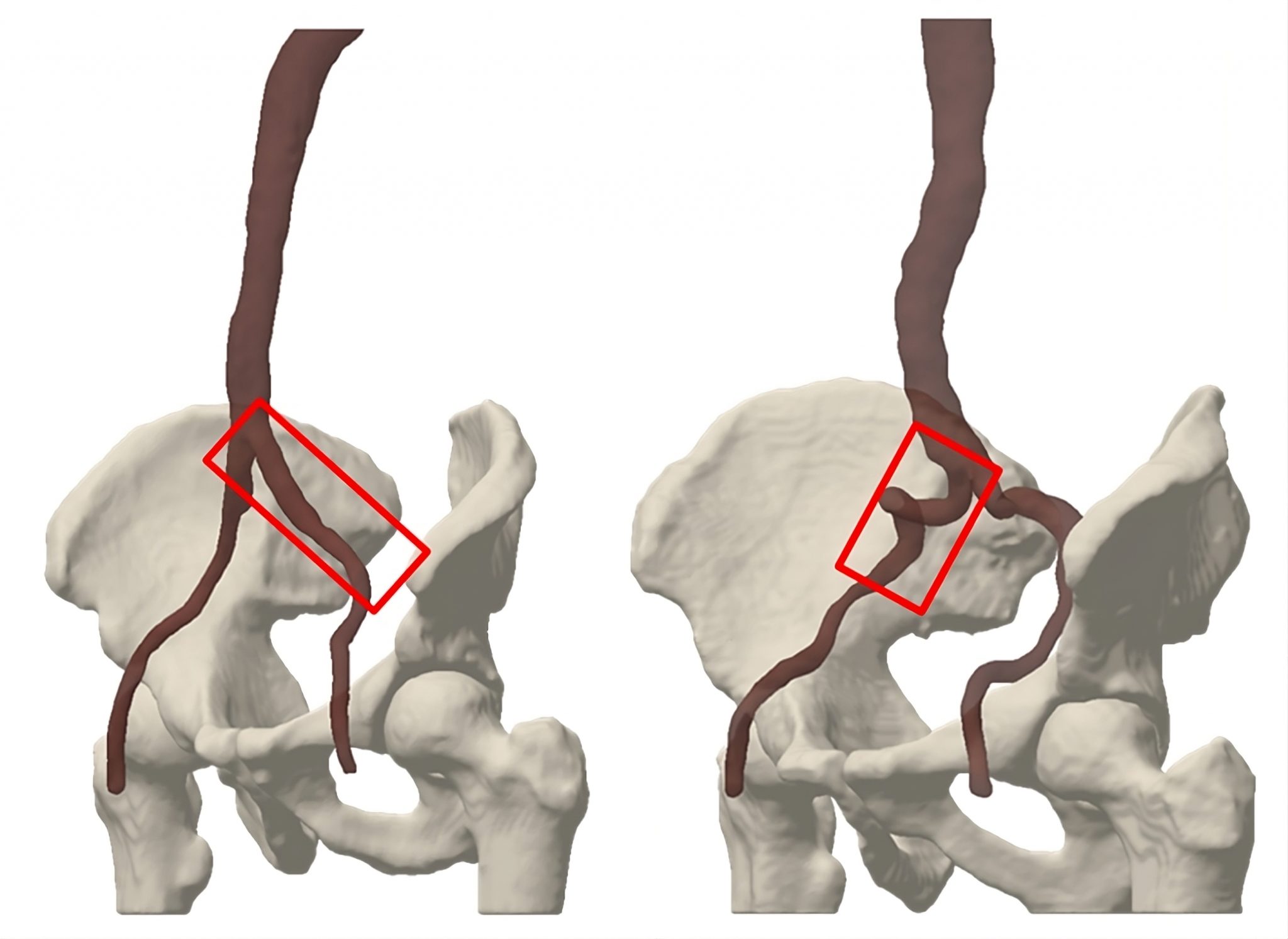 SPH method: What is it and how is it used for medical simulations ...